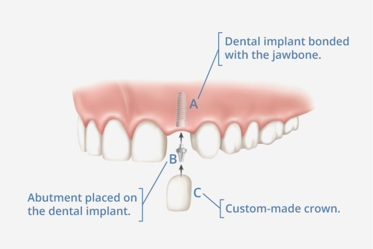 What are Dental Implants? - The Dental Implant Experts - AAID ...